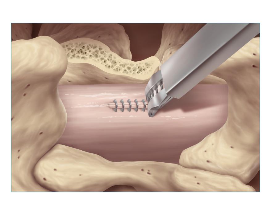 AnastoClip® AC Closure System | LeMaitre