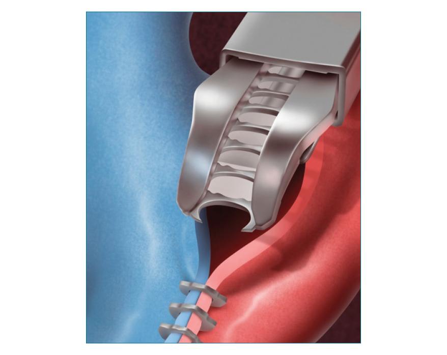 AnastoClip GC® Closure System | LeMaitre