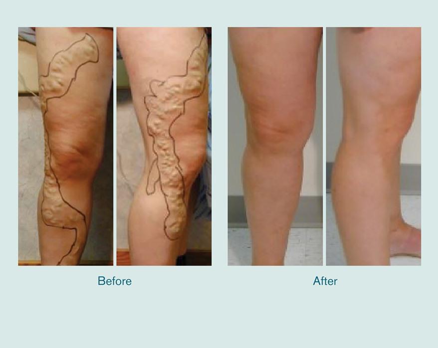 TRIVEX® Transilluminated Powered Phlebectomy System | LeMaitre Vascular