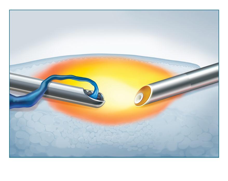 TRIVEX® Transilluminated Powered Phlebectomy System | LeMaitre Vascular